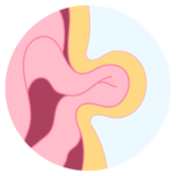 Hernia: Types, Symptoms & Treatment | What Is A Hernia | Blog